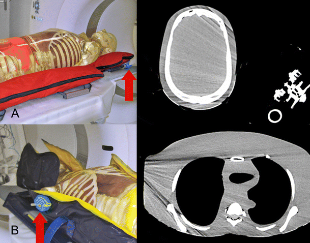 Automatic tube current modulation for whole-body polytrauma CT with ...