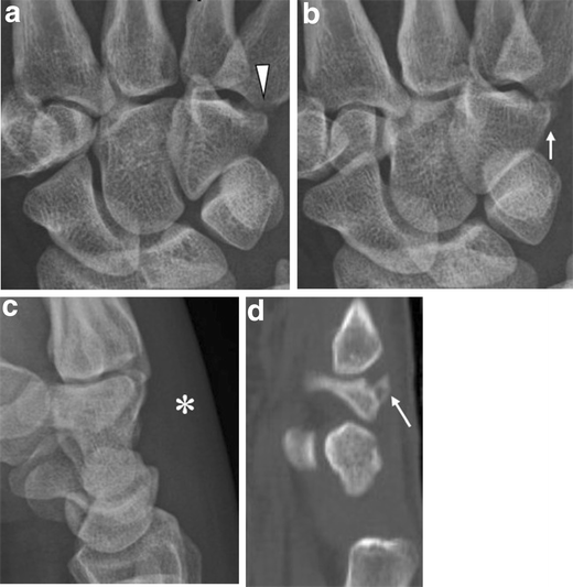 Subtle radiographic signs of hamate body fracture: a diagnosis not to ...
