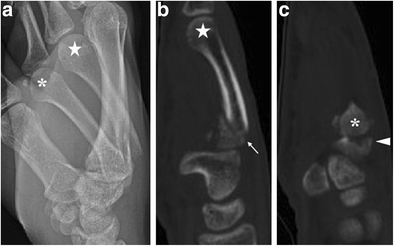 Subtle radiographic signs of hamate body fracture: a diagnosis not to ...
