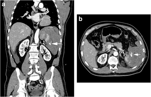 A review of split-bolus single-pass CT in the assessment of trauma ...