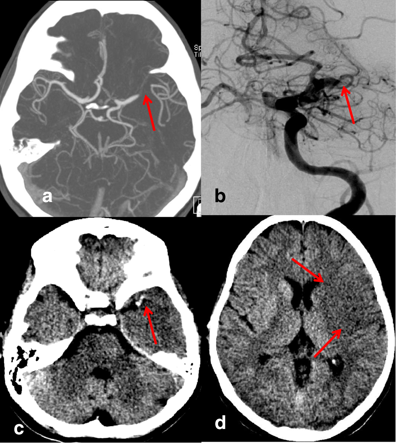 Imaging of acute ischemic stroke | SpringerLink
