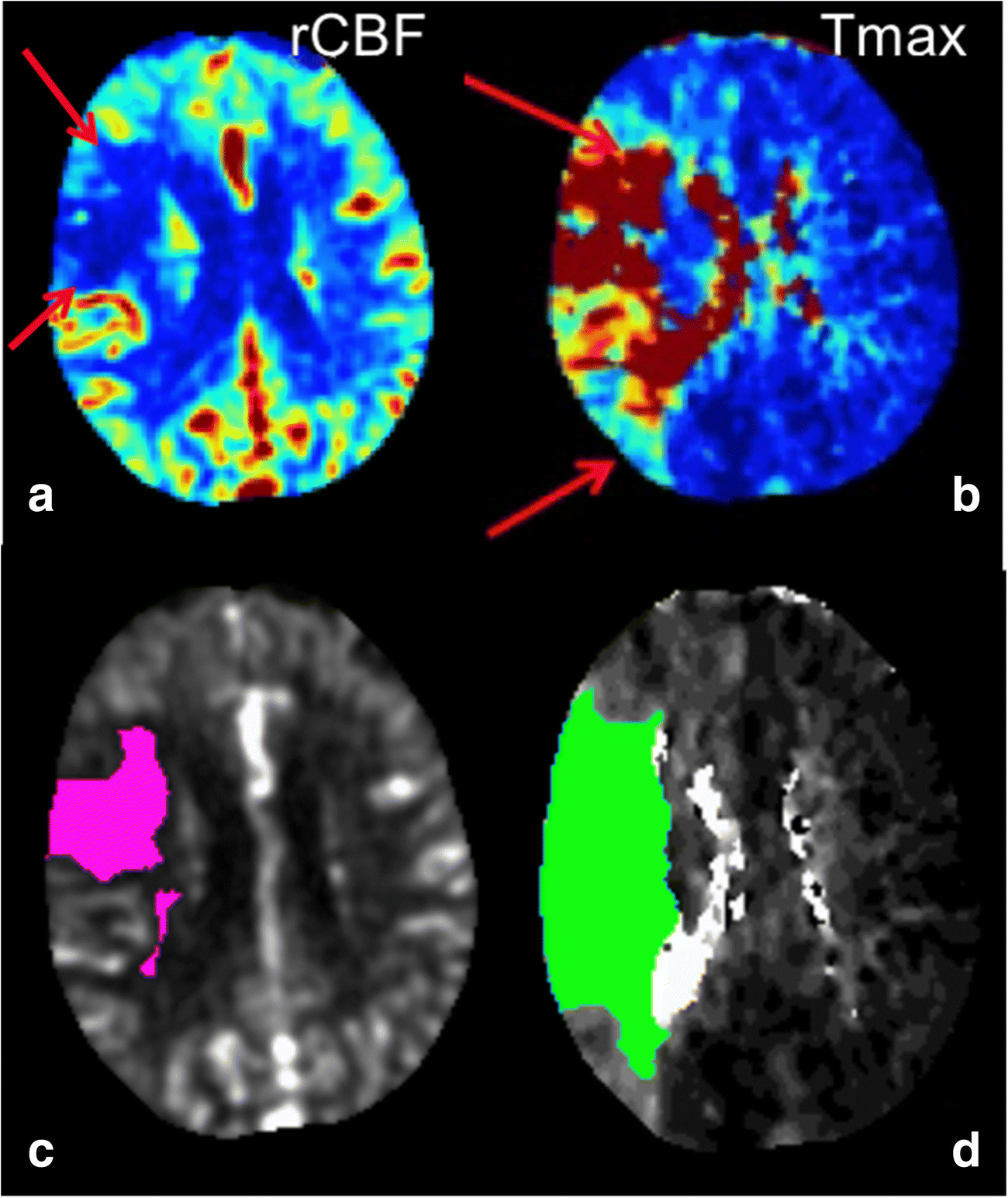 Imaging of acute ischemic stroke | SpringerLink