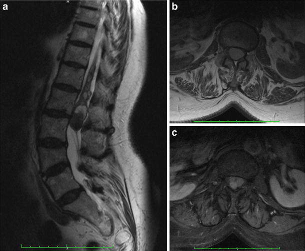 Intramedullary lesions of the conus medullaris: differential diagnosis ...