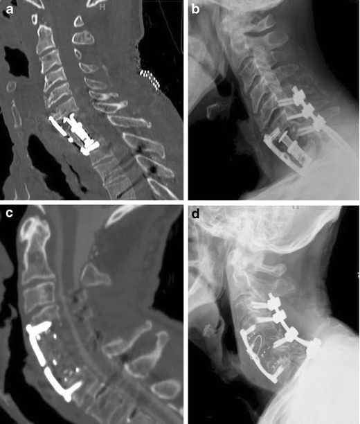 A systematic review of the use of expandable cages in the cervical ...