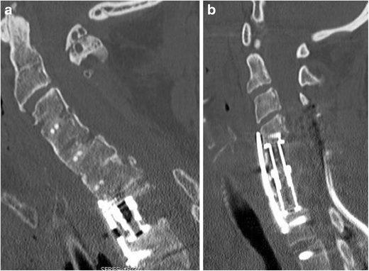 A systematic review of the use of expandable cages in the cervical ...