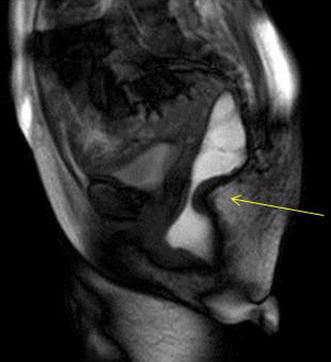 MR-defecography in obstructed defecation syndrome (ODS): technique ...