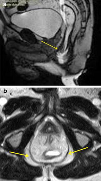 MR-defecography in obstructed defecation syndrome (ODS): technique ...