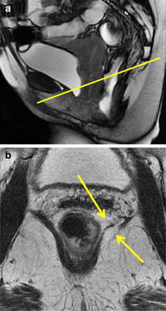 MR-defecography in obstructed defecation syndrome (ODS): technique ...