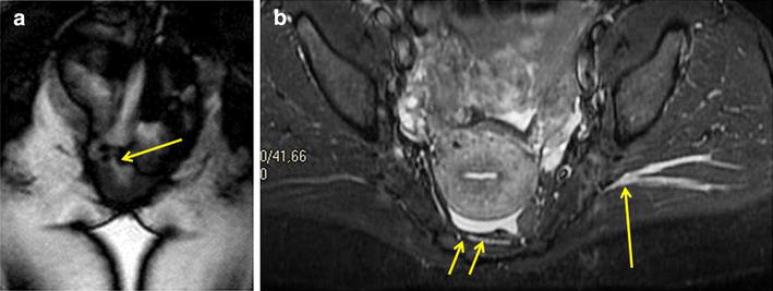 MR-defecography in obstructed defecation syndrome (ODS): technique ...