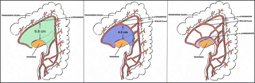 Importance of the Moskowitz artery in the laparoscopic medial approach ...