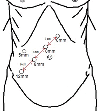 Neurovascular sparing robotic high anterior resection–technical note ...