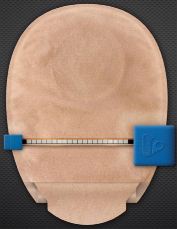 The Ostom-i™ Alert Sensor: a new device to measure stoma output ...