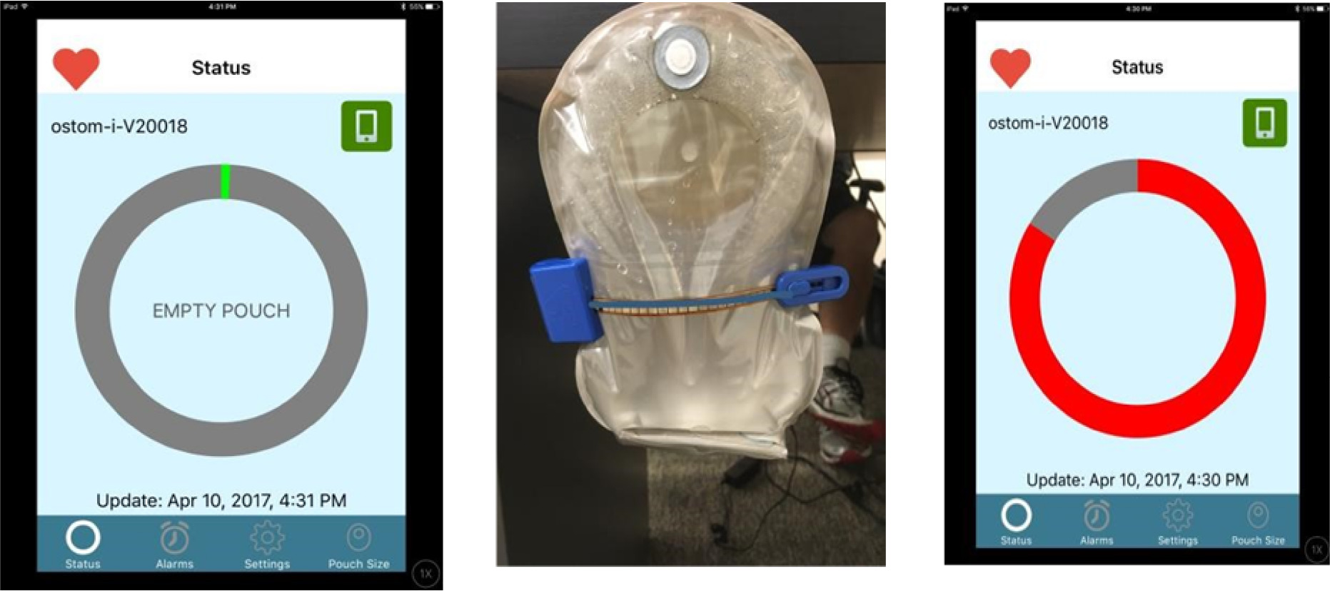 The Ostom-i™ Alert Sensor: a new device to measure stoma output ...