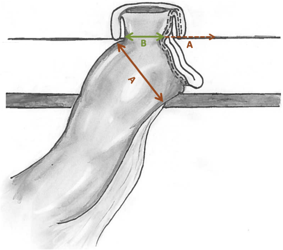 The “Cone” stoma: stoma creation in the presence of significant bowel ...
