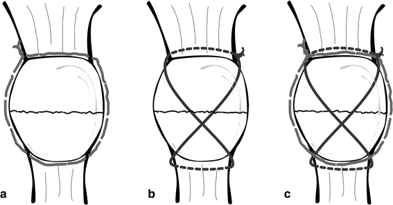 FiberWire tension band for patellar fractures | SpringerLink