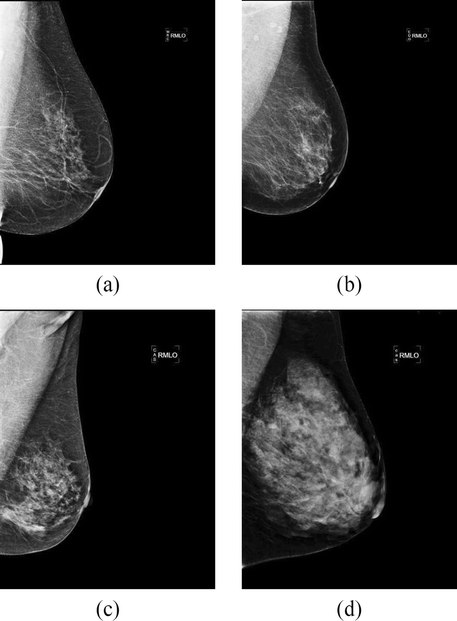 Breast Density Analysis Using an Automatic Density Segmentation ...