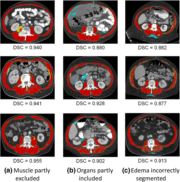 Pixel-Level Deep Segmentation: Artificial Intelligence Quantifies Muscle on Computed Tomography ...