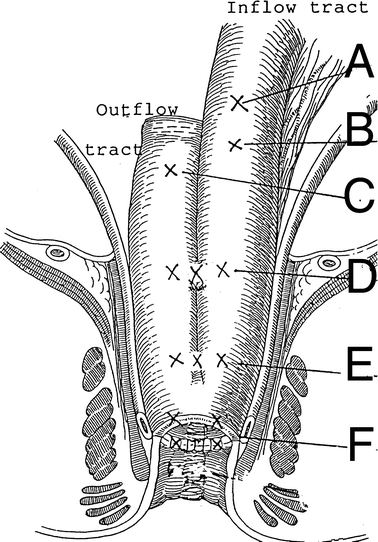 Mucosal Dysplasia in Ileal Pelvic Pouches After Restorative ...