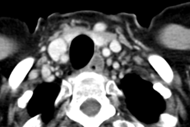 Lymphangioma of the cervical esophagus associated with an inlet patch ...