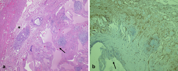 Lymphangioma of the cervical esophagus associated with an inlet patch ...