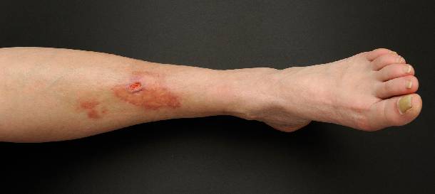 Differentialdiagnose der Hautveränderungen an den Beinen bei CVI ...