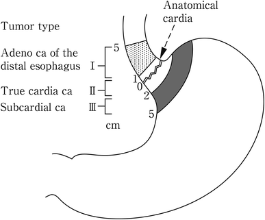 Japanese Classification of Esophageal Cancer, 11th Edition: part II and ...