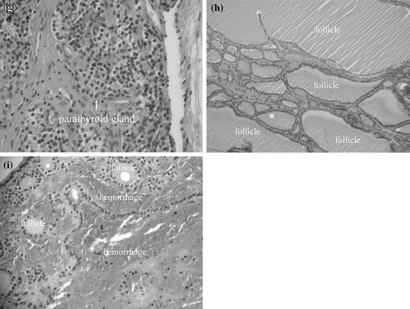 An accessory thyroid gland that presented tumor-like images | SpringerLink