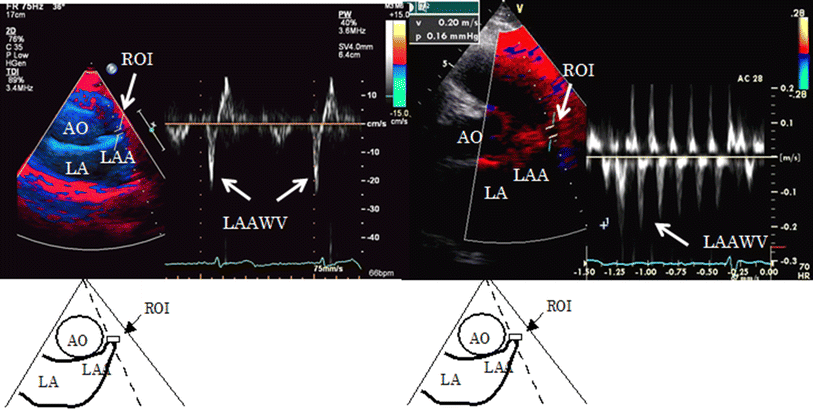 Relevance of transthoracic left atrial appendage wall velocity ...