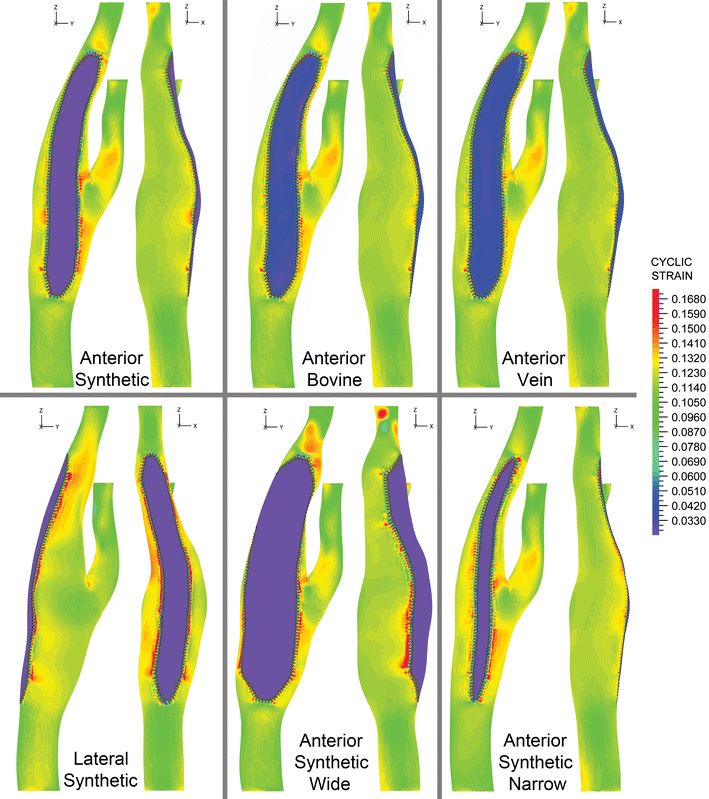 Hemodynamically Motivated Choice of Patch Angioplasty for the ...