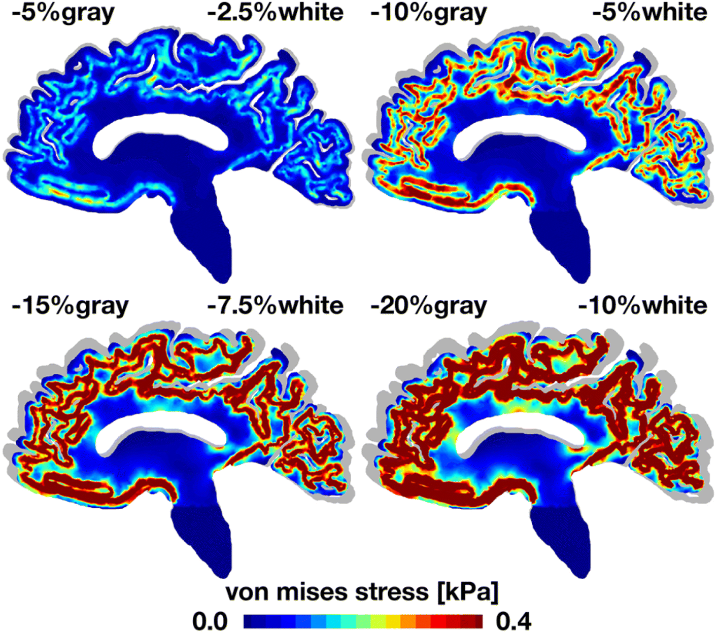 The Shrinking Brain: Cerebral Atrophy Following Traumatic Brain Injury ...