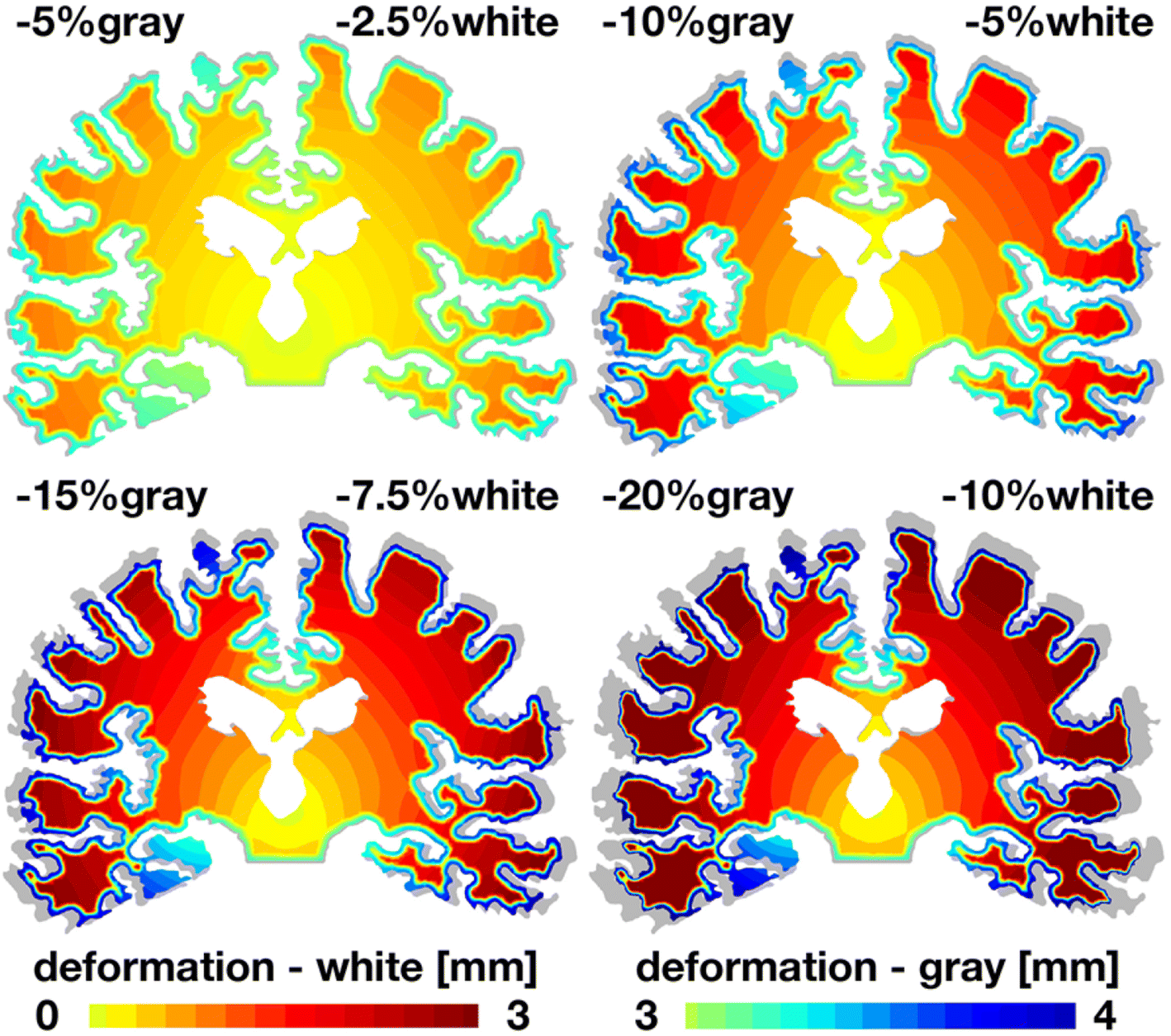 The Shrinking Brain: Cerebral Atrophy Following Traumatic Brain Injury ...