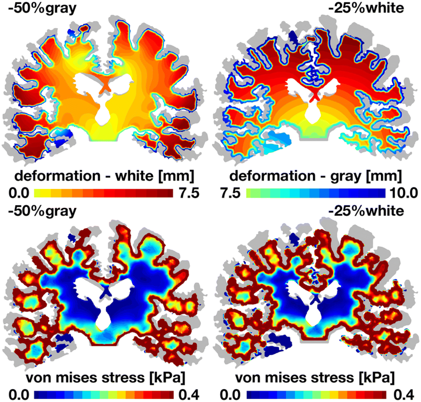 The Shrinking Brain: Cerebral Atrophy Following Traumatic Brain Injury ...