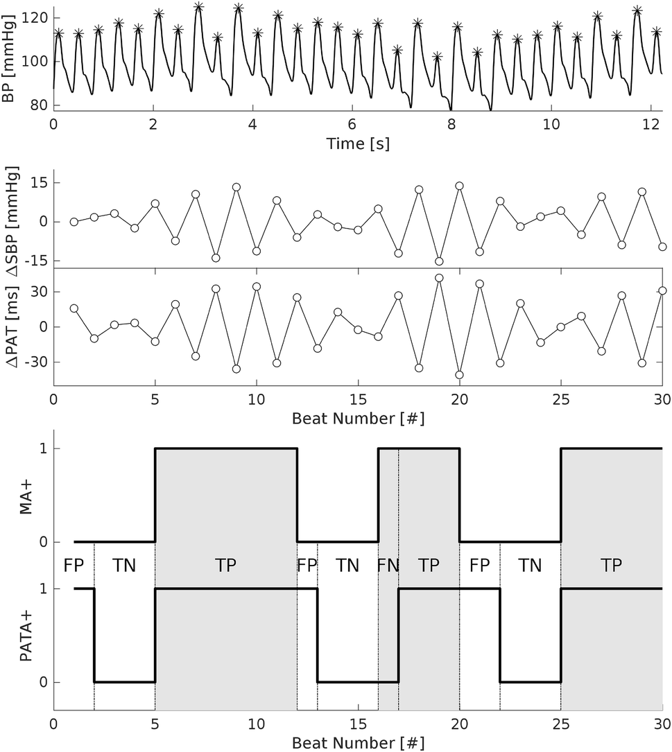 Pulse Arrival Time and Pulse Interval as Accurate Markers to Detect ...