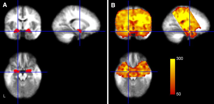 A 7 Tesla fMRI Study of Amygdala Responses to Fearful Faces | SpringerLink