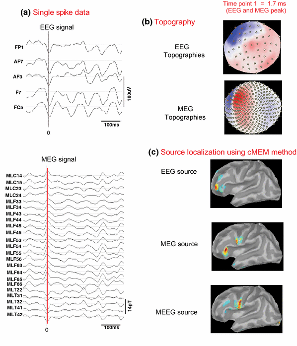 MEG–EEG Information Fusion and Electromagnetic Source Imaging: From Theory to Clinical ...