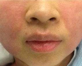 Tamoxifen-associated skin reactions in breast cancer patients: from ...