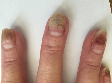 A double-blind, randomised trial of a polyphenolic-rich nail bed balm ...