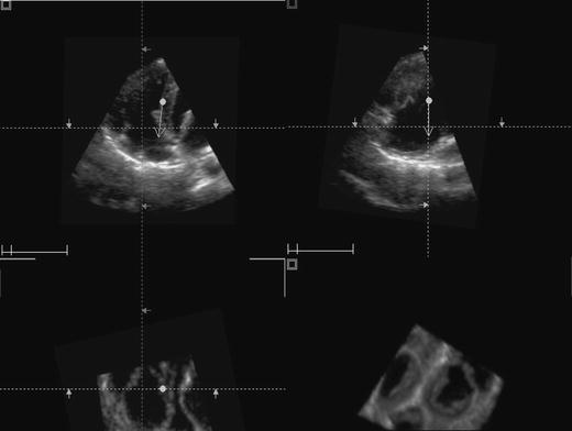 Assessment of normal tricuspid valve anatomy in adults by real-time ...