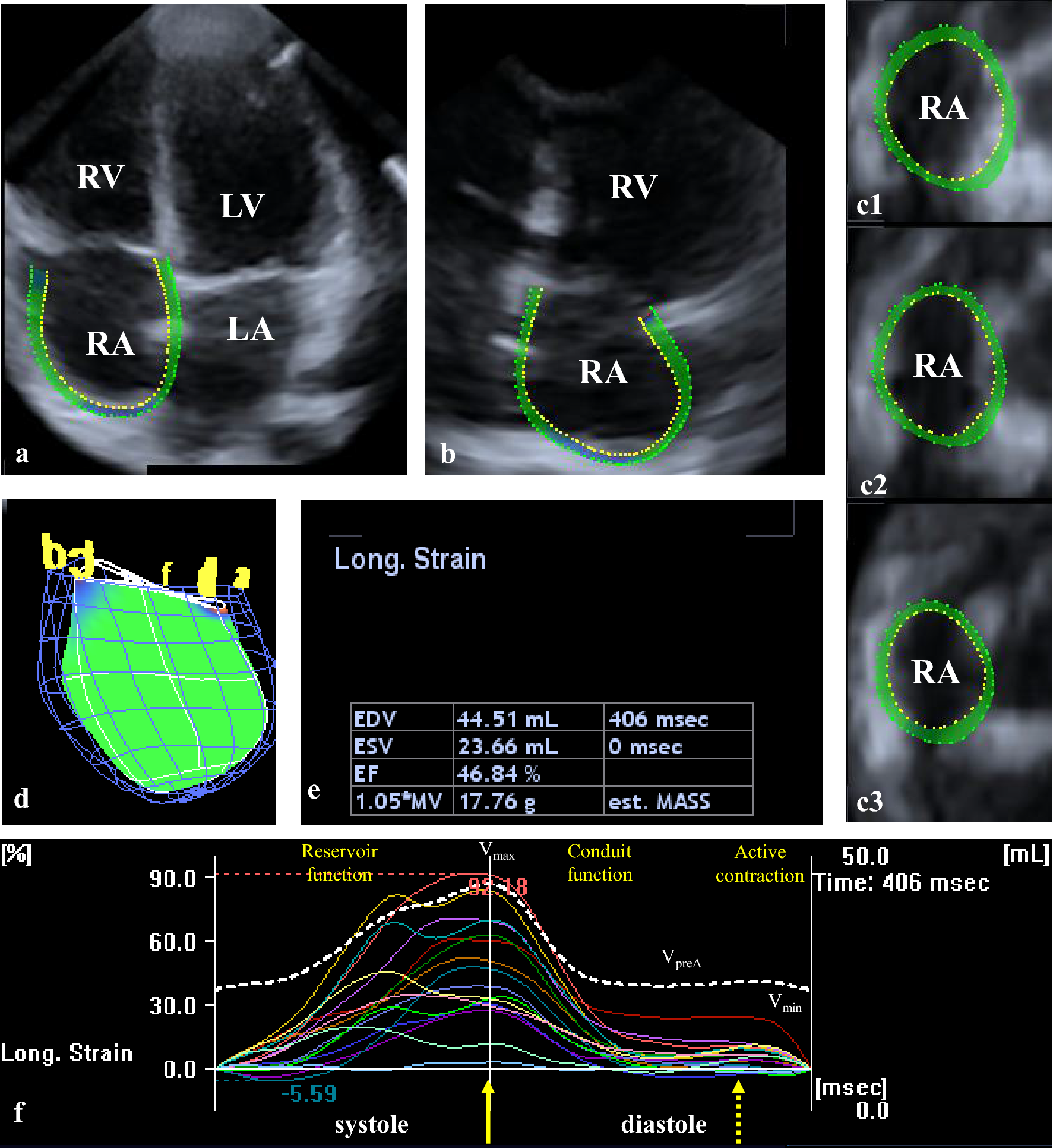 Normal reference values of right atrial strain parameters using three ...
