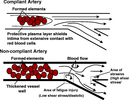 Importance of Blood Rheology in the Pathophysiology of Atherothrombosis ...