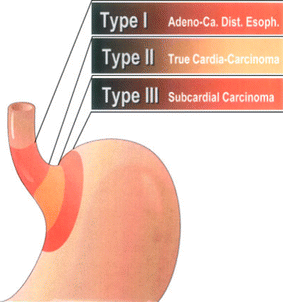 Gastric Cardia Cancer: How Much Is It from Fat? | SpringerLink