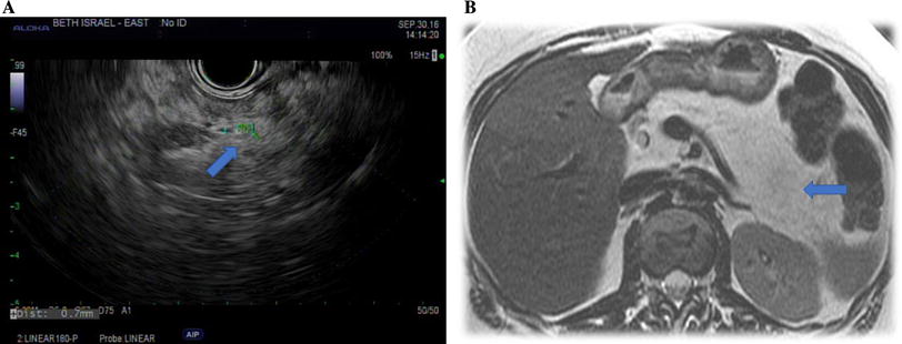 The Clinical Implications of Fatty Pancreas: A Concise Review ...