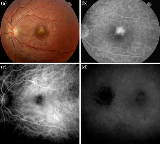 Transient electro-oculogram impairment in unilateral acute idiopathic ...