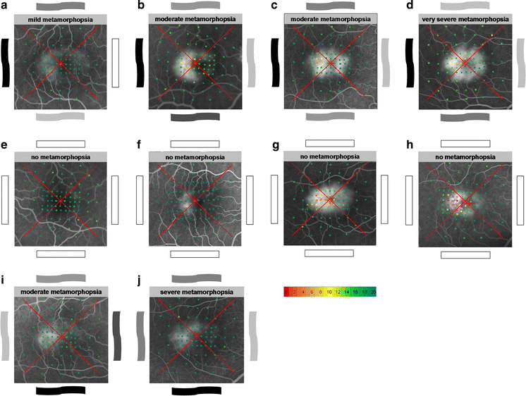 Metamorphopsia in patients with macular telangiectasia type 2 ...