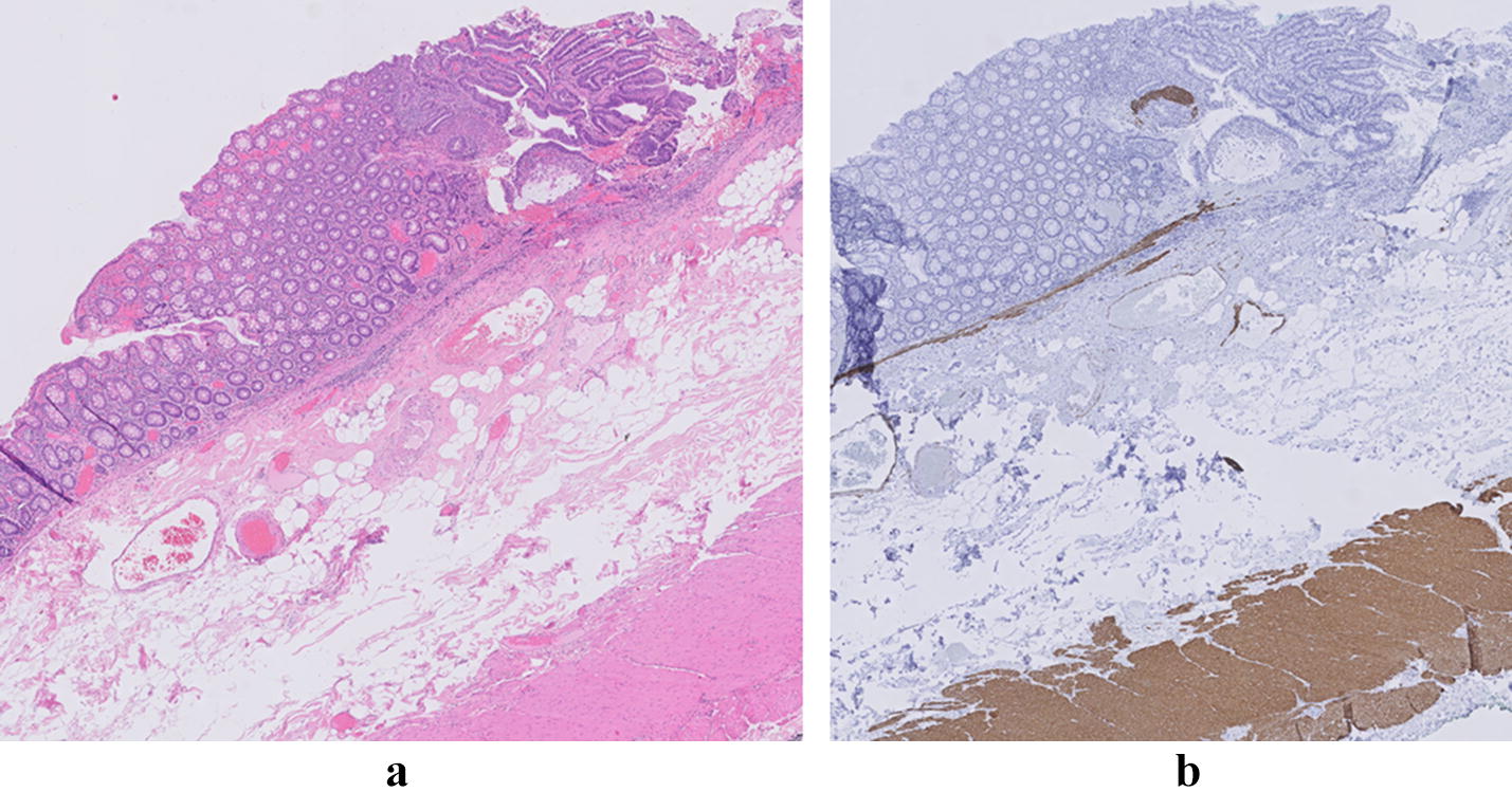 Endoscopic full thickness resection for early colon cancer in Lynch ...