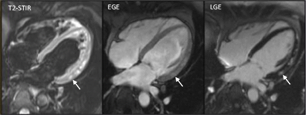 T2 mapping and T2* imaging in heart failure | SpringerLink