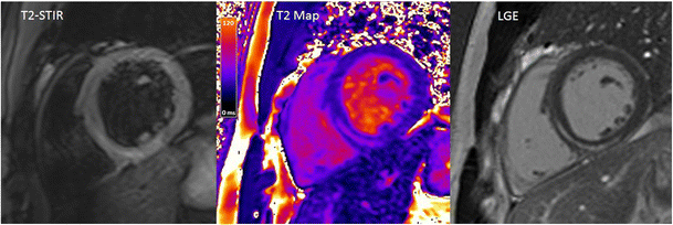 T2 mapping and T2* imaging in heart failure | SpringerLink