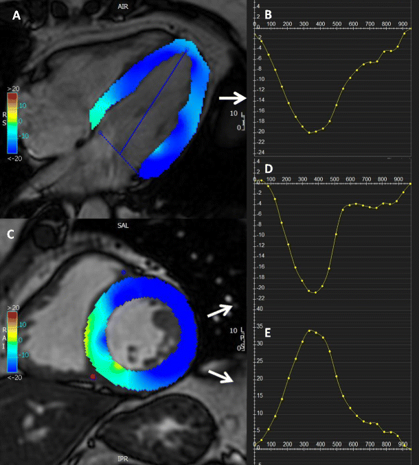 Strain imaging using cardiac magnetic resonance | SpringerLink