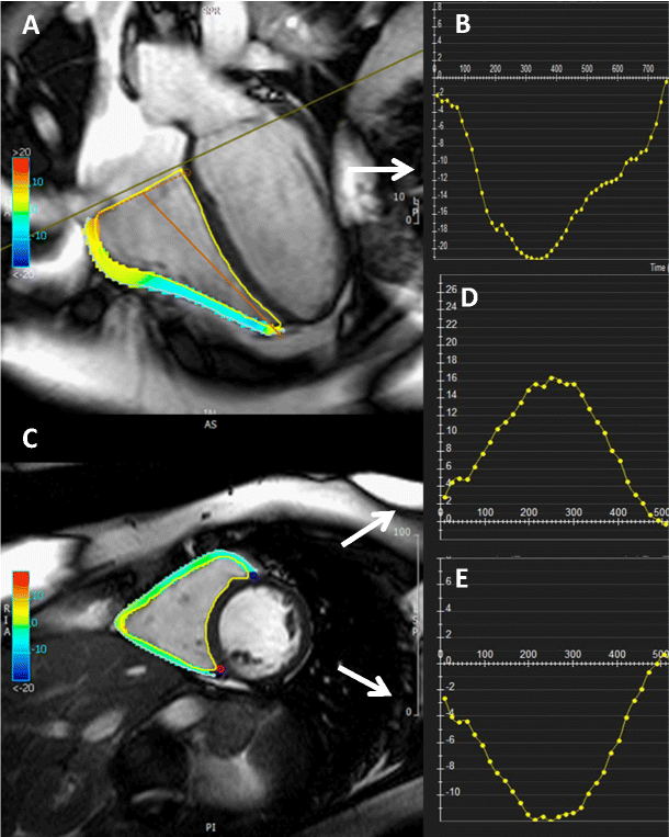 Strain imaging using cardiac magnetic resonance | SpringerLink