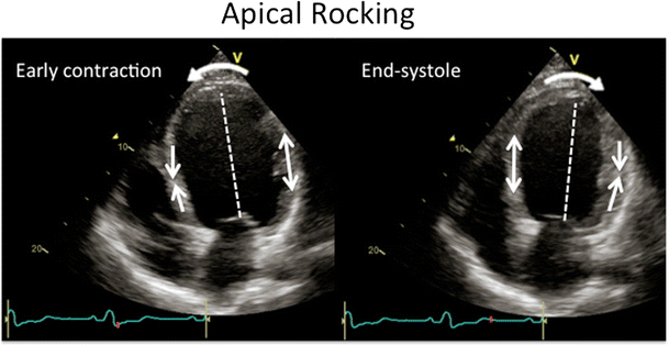 Current role of echocardiography in cardiac resynchronization therapy ...